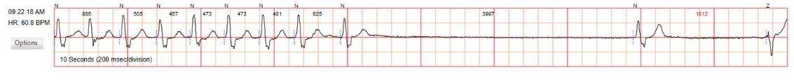 Figure 3 Offset rhythm with 4-second pause - Cardiac Insight