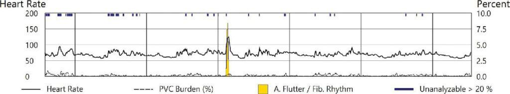 Case Studies - Main - Cardea SOLO™ Captures AFIB On Day 3 - Cardiac ...
