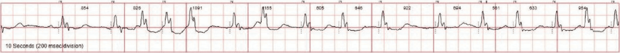 Case Studies - Main - Cardea SOLO™ Captures AFIB On Day 3 - Cardiac ...