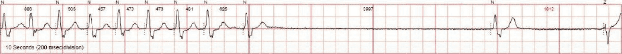 Case Studies - Main - Cardea SOLO™ Captures AFIB On Day 3 - Cardiac ...