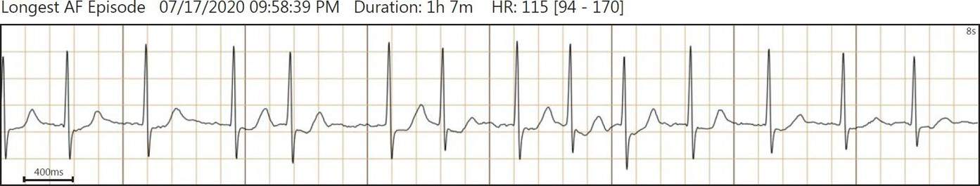 Case Studies - Interventional Cardiologist uses Cardea SOLOTM Wearable ...