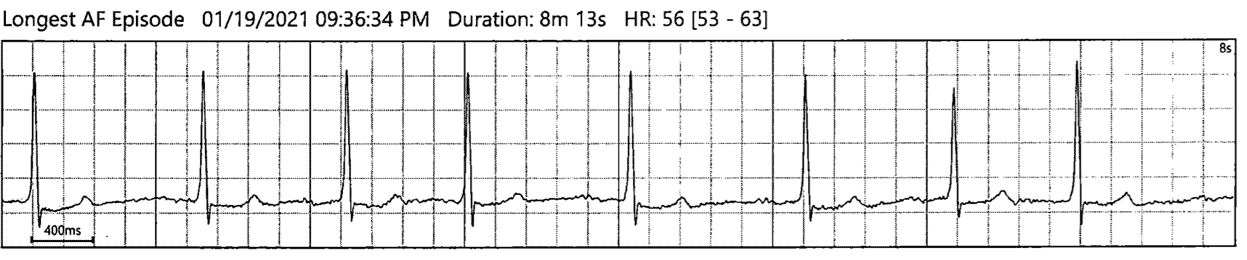 Case Studies - New Onset AF Detected Early by Cardea SOLO ...