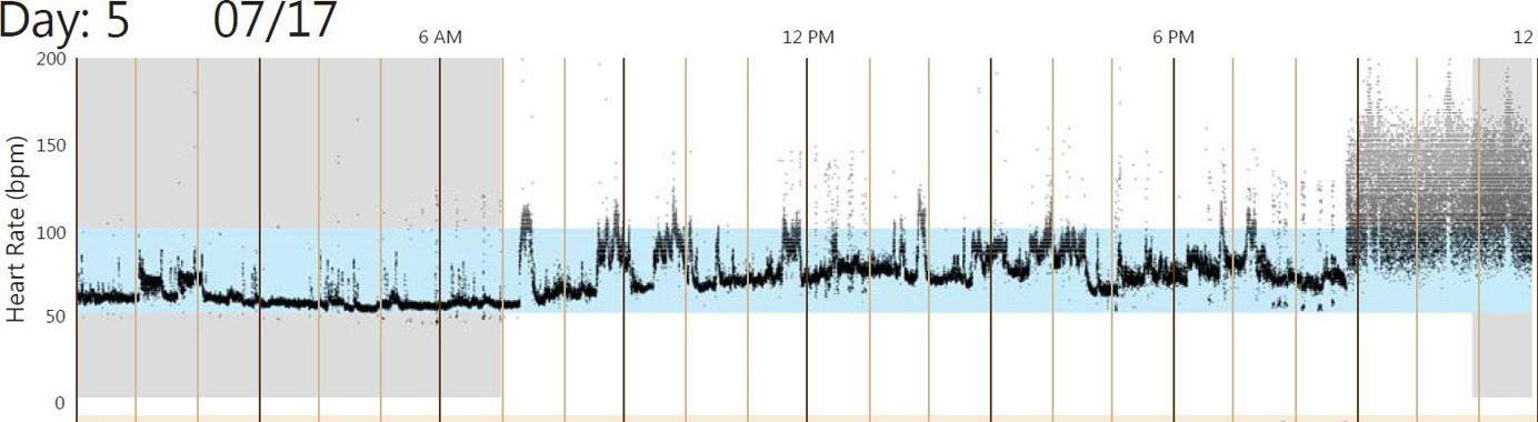 Case Studies - Interventional Cardiologist uses Cardea SOLOTM Wearable ...