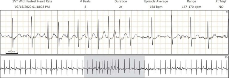 Case Studies - Interventional Cardiologist uses Cardea SOLOTM Wearable ...
