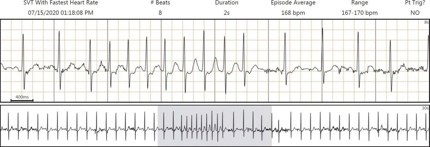 Case Studies - Interventional Cardiologist uses Cardea SOLOTM Wearable ...