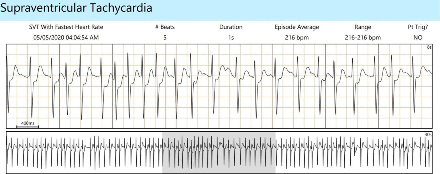Case Studies - Primary Care Practice detects AF with Cardea SOLO ...