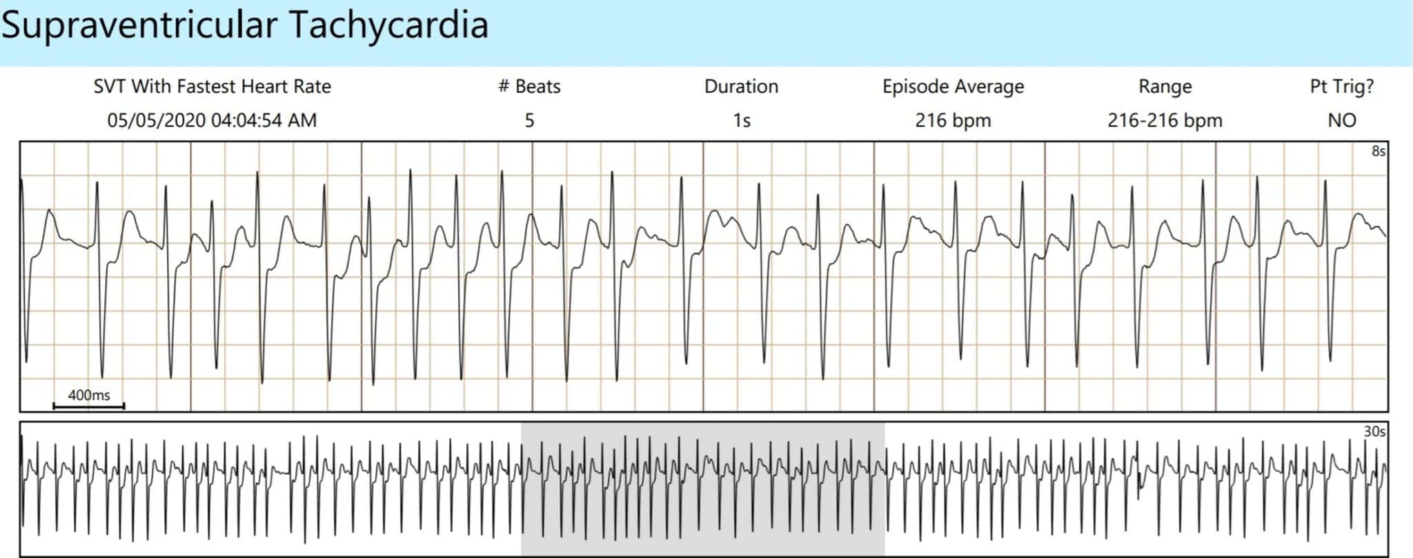 Case Studies - Primary Care Practice detects AF with Cardea SOLO ...